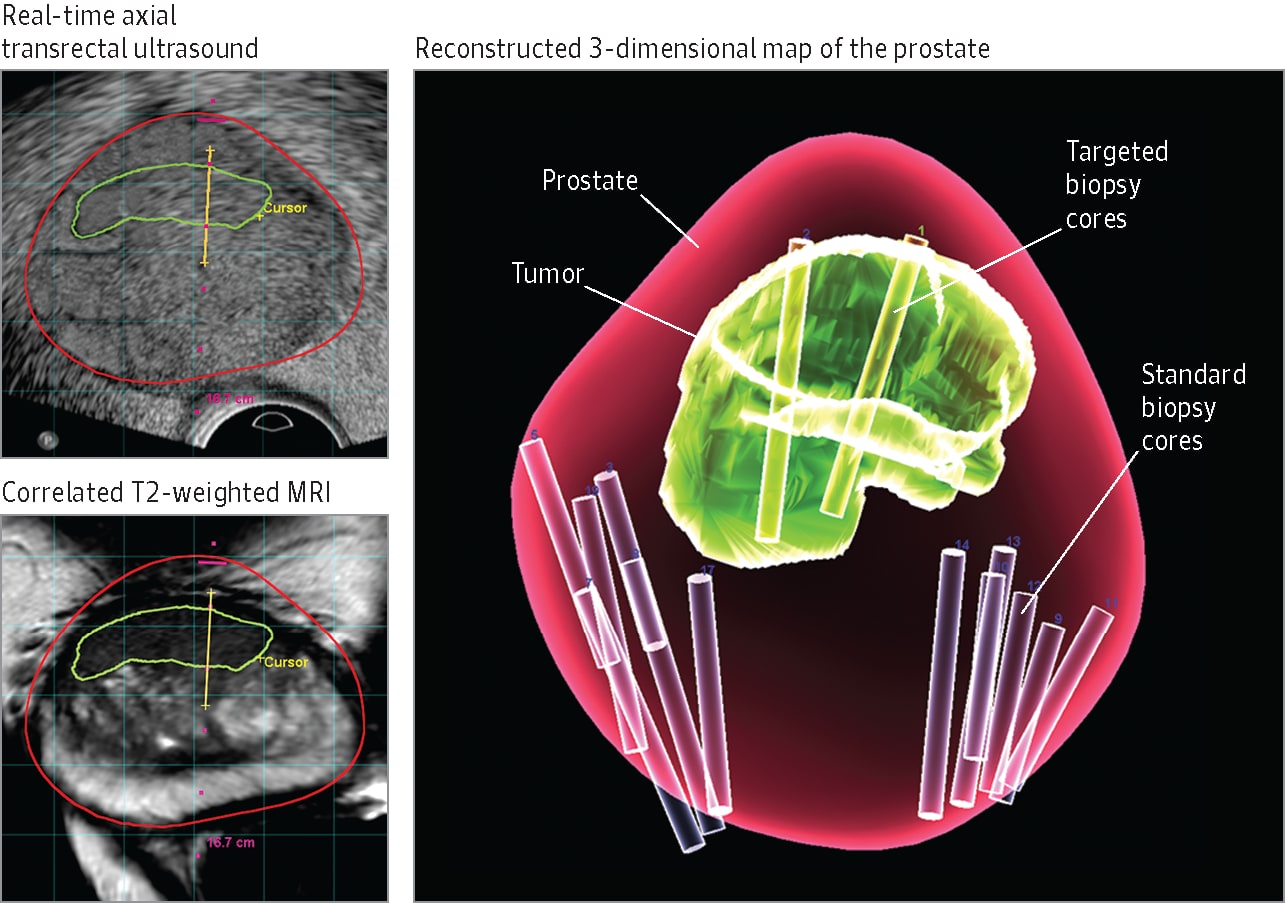 #EAU18. STUDIU. Biopsia țintită, ghidată prin RMN – superioară biopsiei ...