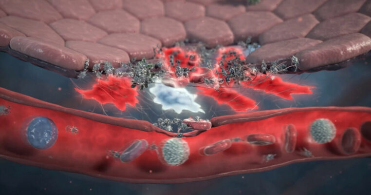 Fibroză pulmonară idiopatică