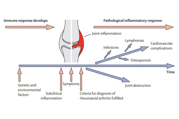 #EULAR2019. Tratamentul poliartritei reumatoide ar trebui să ia în ...