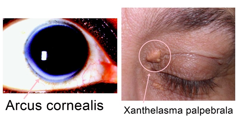 #RareDiseaseDay. Hipercolesterolemia familială homozigotă: o boală ...