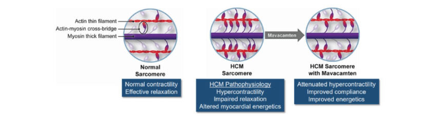 FDA a aprobat mavacamten, primul tratament specific pentru ...