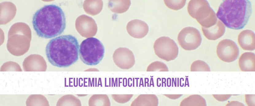 FAQ Leucemia limfocitară cronică